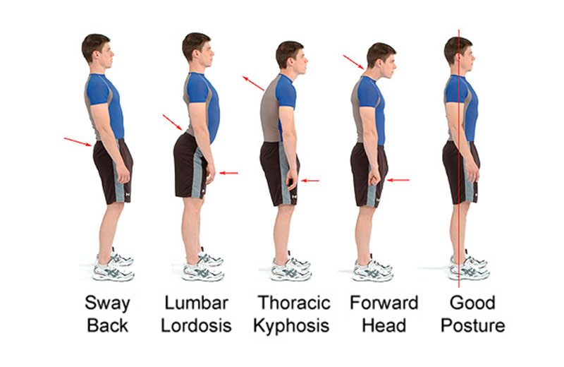 Postural Syndrome/Pain | Rehab Basics